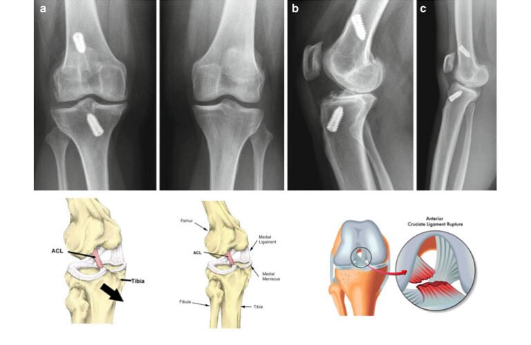 Chronic ACL Injury & Its Cause, Symptom & Treatment | ASPC Manipulation ...