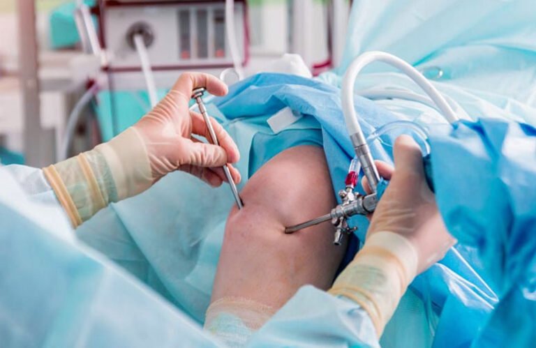 Acute ACL Injury & Its Causes, Sign-Symptom & Treatment | ASPC ...