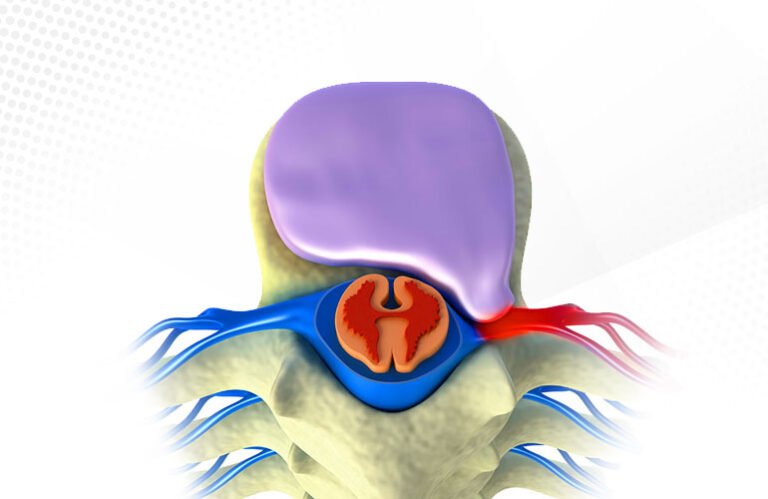 Radiating Pain Explained: What Causes It and How to Treat It | ASPC ...