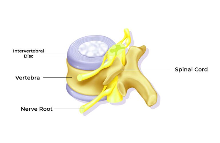 The Connection Between Lumbar Herniated Disc and Sciatic Pain: A ...