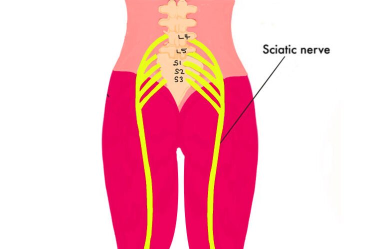 The Connection Between Lumbar Herniated Disc and Sciatic Pain: A ...