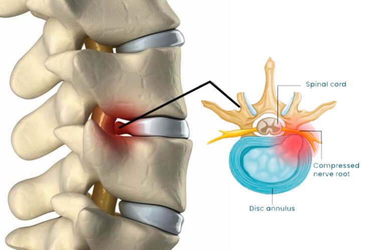 Does a Hernia Cause Back Pain? Let's Find Out | ASPC Manipulation Therapy