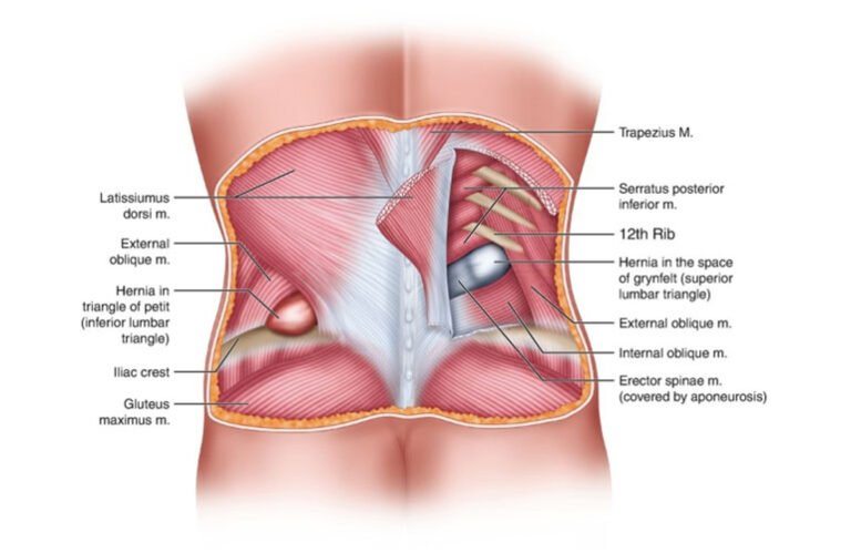 Does a Hernia Cause Back Pain? Let's Find Out | ASPC Manipulation Therapy