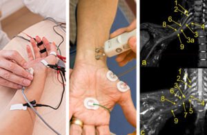 Understanding Brachial Plexus Neuropathy: An Overview of Parsonage ...