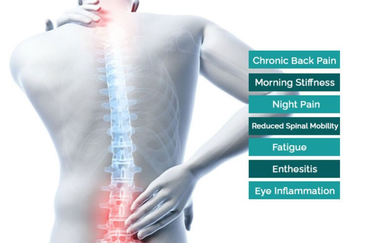 Is Your Shoulder Pain Related to Ankylosing Spondylitis? | ASPC ...