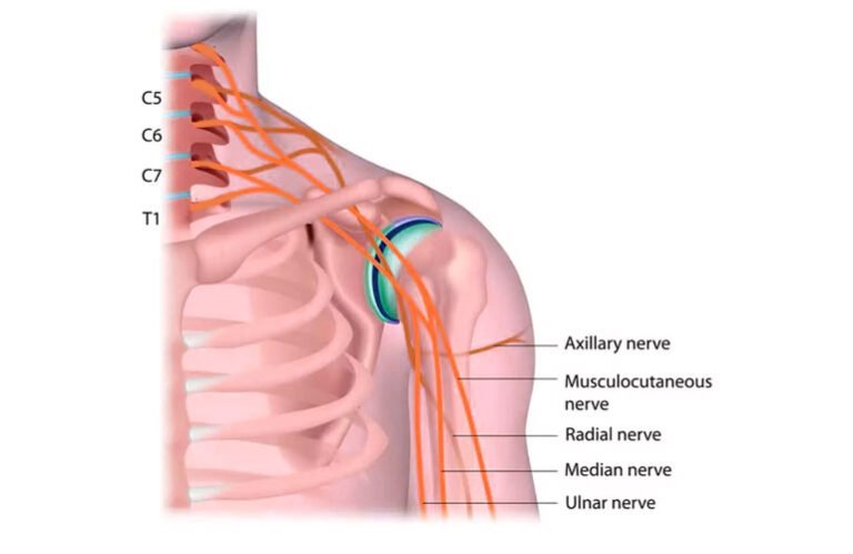 Understanding Brachial Plexus Neuropathy: An Overview of Parsonage ...