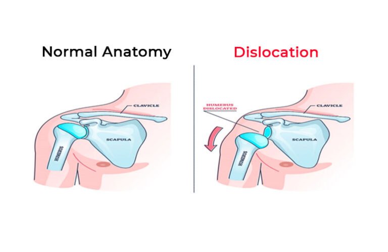 Physiotherapy interventions for Dislocated Shoulder Patients | ASPC ...