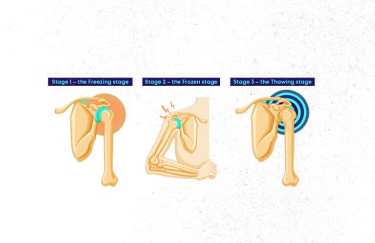 How Hormonal Changes During Menopause Affect Frozen Shoulder Risk ...