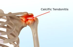 What is Calcific Tendonitis? A Comprehensive Overview | ASPC ...