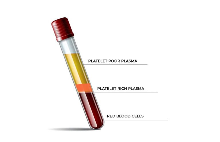 How Effective is PRP in Addressing Knee Osteoarthritis Symptoms? | ASPC ...