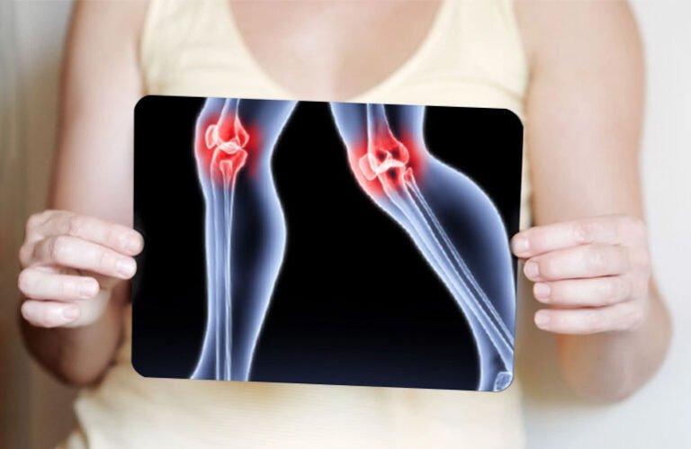 Exploring Knee Osteoarthritis: Stages, Medial Compartmental OA, and the ...