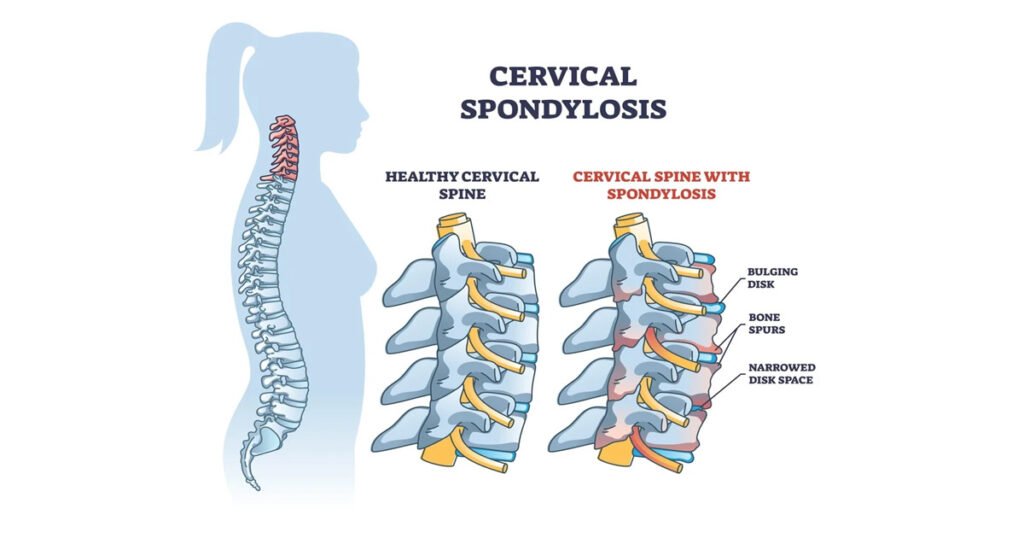 Cervical spondylosis exercises | ASPC Manipulation Therapy